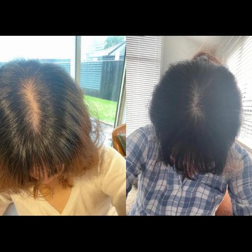 Normal Hair At Crown Part